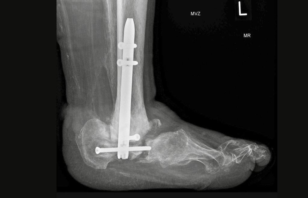 Optionen der inneren Fixation bei Charcot-Arthropathie - Orthopädie ...