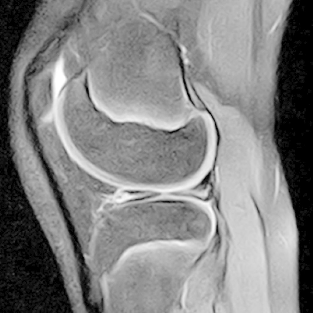 Scheibenmeniskus bei Kindern und Jugendlichen - Orthopädie ...