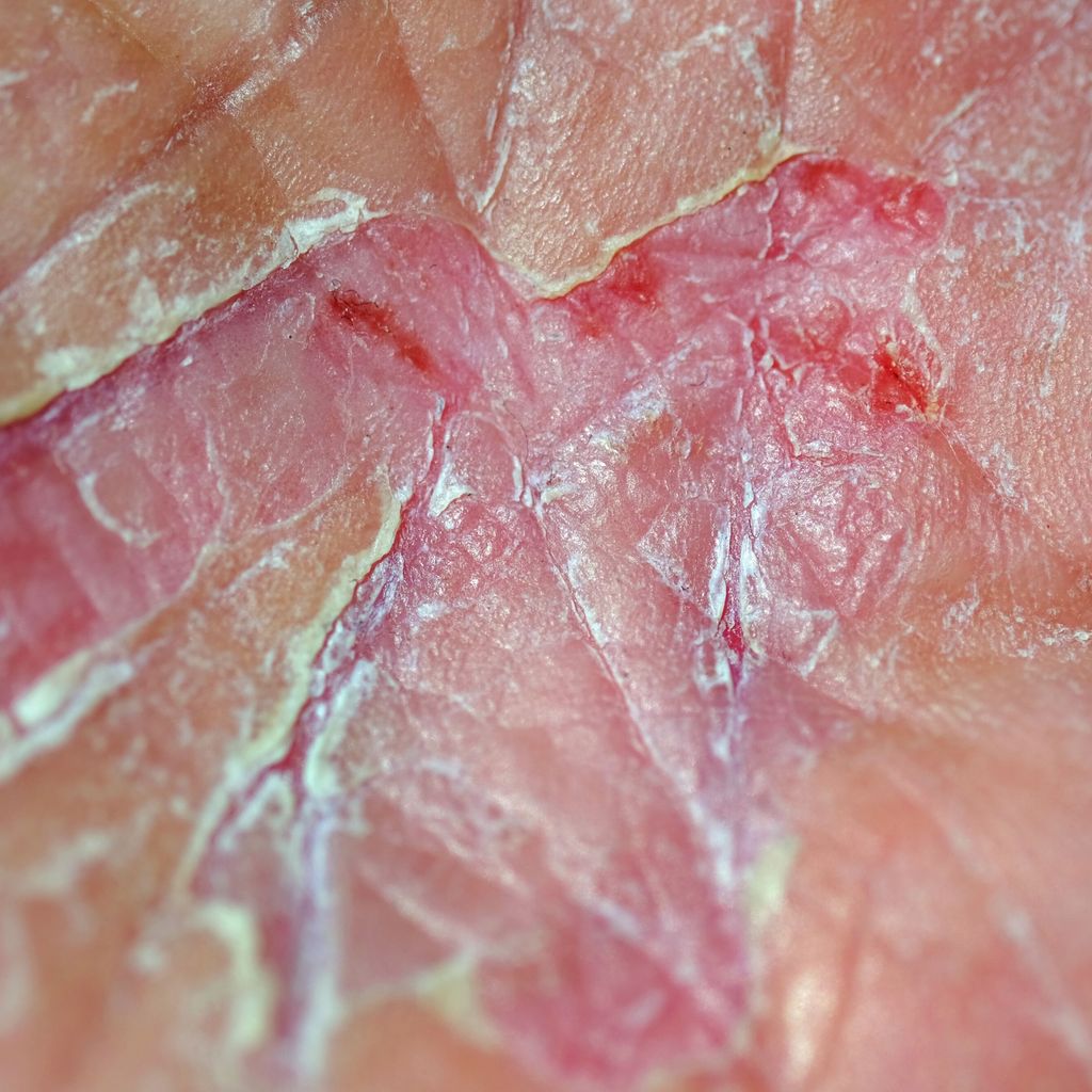 Behandlungspfad „Atopische Dermatitis“ - Dermatologie - Universimed ...